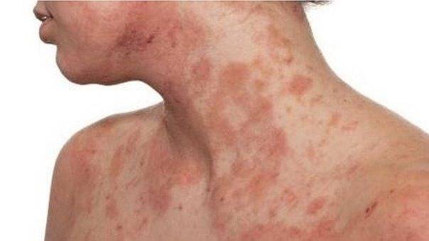Según los especialistas, la dermatitis atópica no es solo un brote en ...